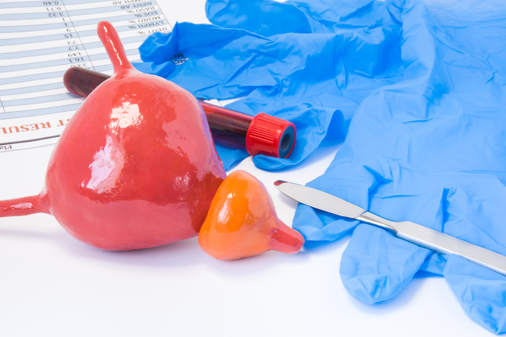 Cirugía de Próstata | Dr. Alfredo Rodríguez